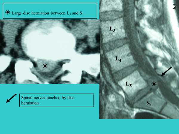 IRRADIATION DE LA DOULEUR ET PICOTEMENS / FOURMILLEMENTS DANS LES ...
